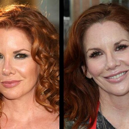 Melissa Gilbert's Stunning Transformation: Plastic Surgery Secrets ...