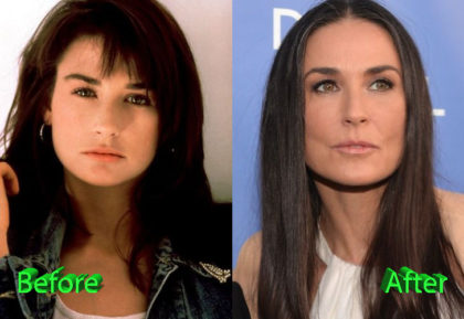 Demi Moore Before and After Cosmetic Surgery - Plastic Surgery Mistakes