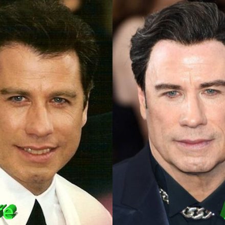 John Travolta Before and After Cosmetic Surgery - Plastic Surgery Mistakes