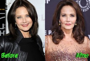 Lynda Carter Before and After Cosmetic Surgery - Plastic Surgery Mistakes